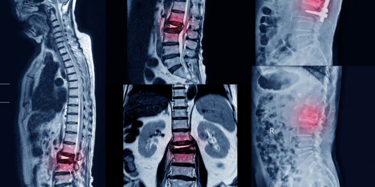 Fractura vertebral: Causas, síntomas y tratamientos